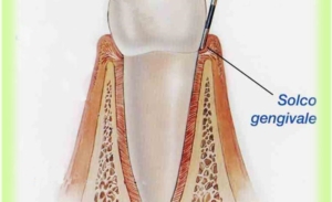 Piorrea:quali sono i primi sintomi?Tutte le cure disponibili| Dentista ...